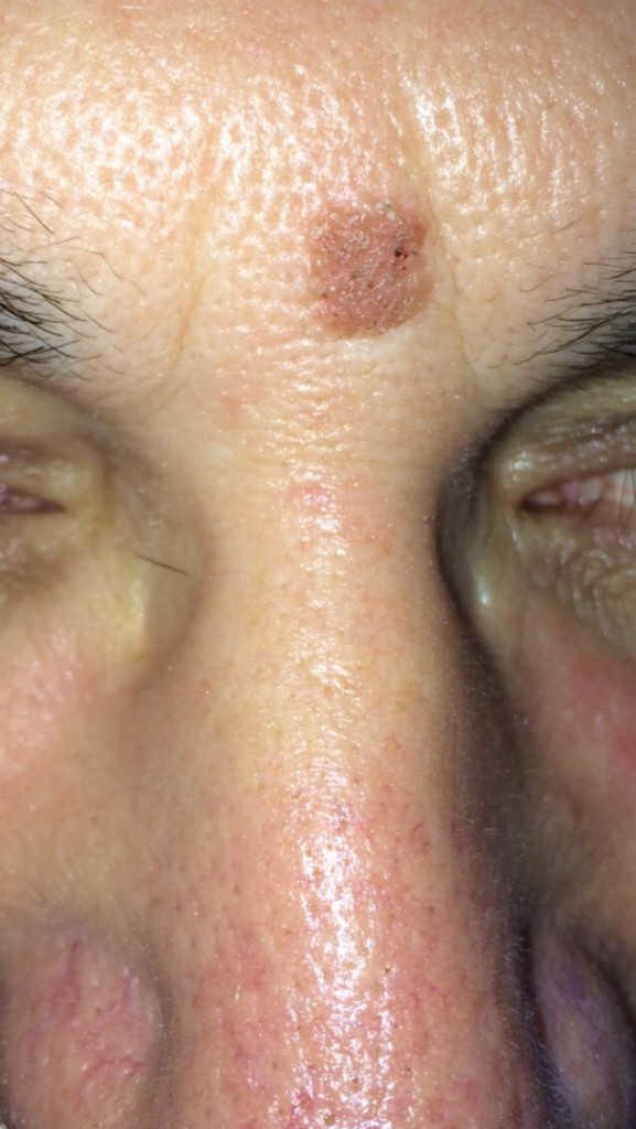 Skin Cancer, Melanoma, skin disease, skin growth, mole
